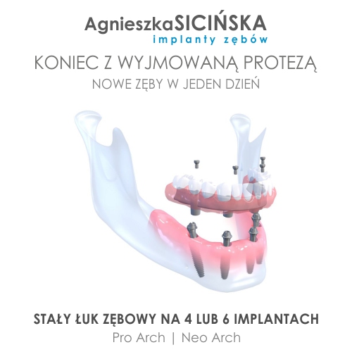 Nowe zęby w jeden dzień, implanty zębów – Warszawa | Agnieszka Sicińska