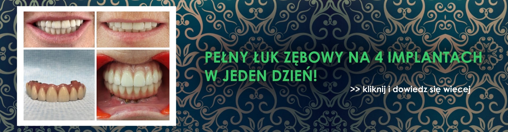 Implanty zębów, allon4, dentysta, stomatolog - Warszawa | Agnieszka ...