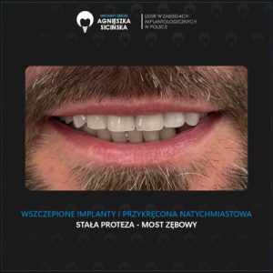 Most zębowy na implantach w jeden dzień na 1 wizycie